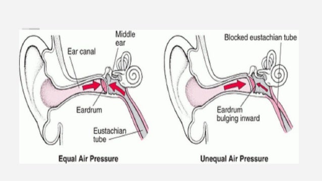 Barotrauma Guide Causes Symptoms And Treatment Options