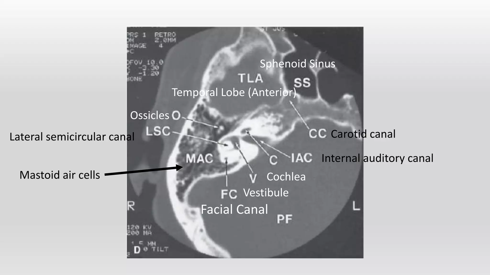 Ear carcinoma | PPTX