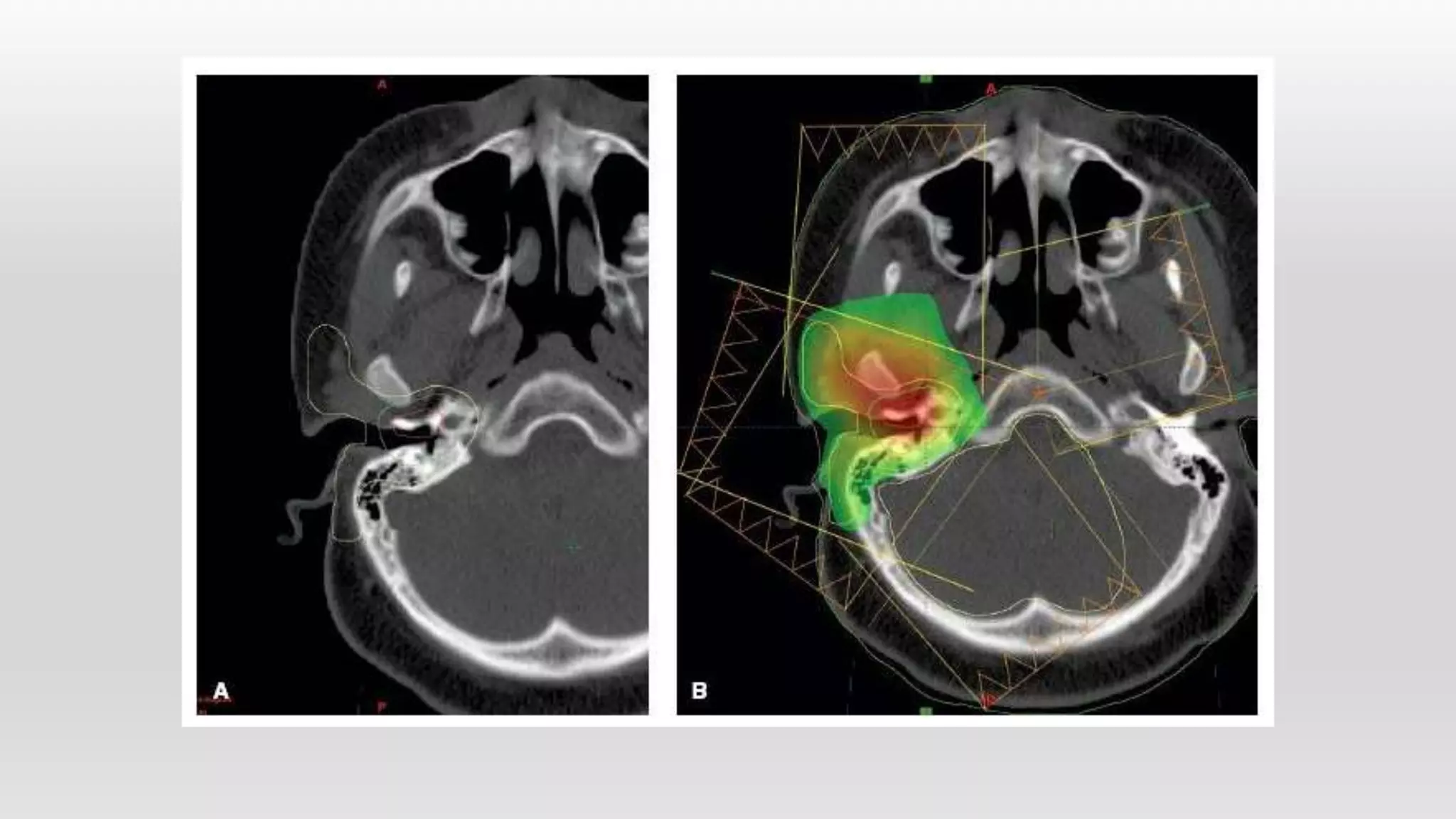 Ear carcinoma | PPTX