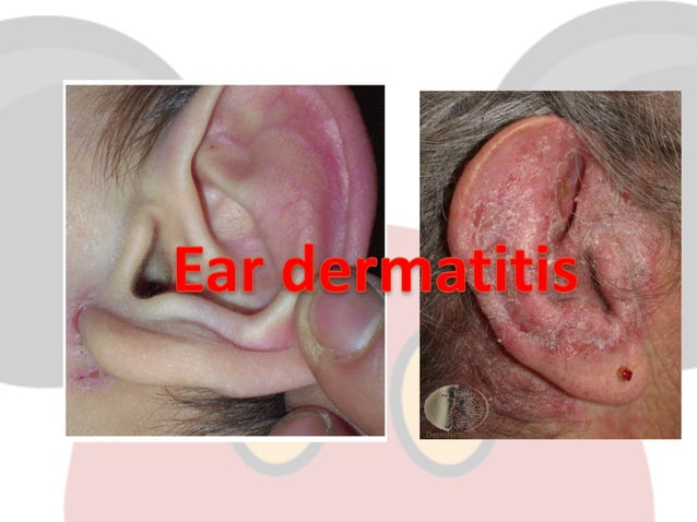 Ear Dermatosis - Dr Maryam K Alnajem | PPT