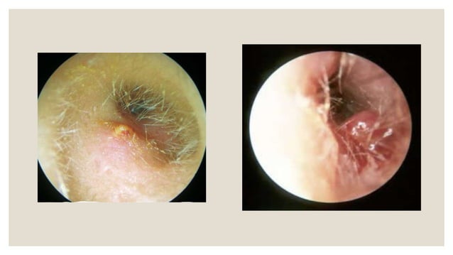 ear discharge.pptx