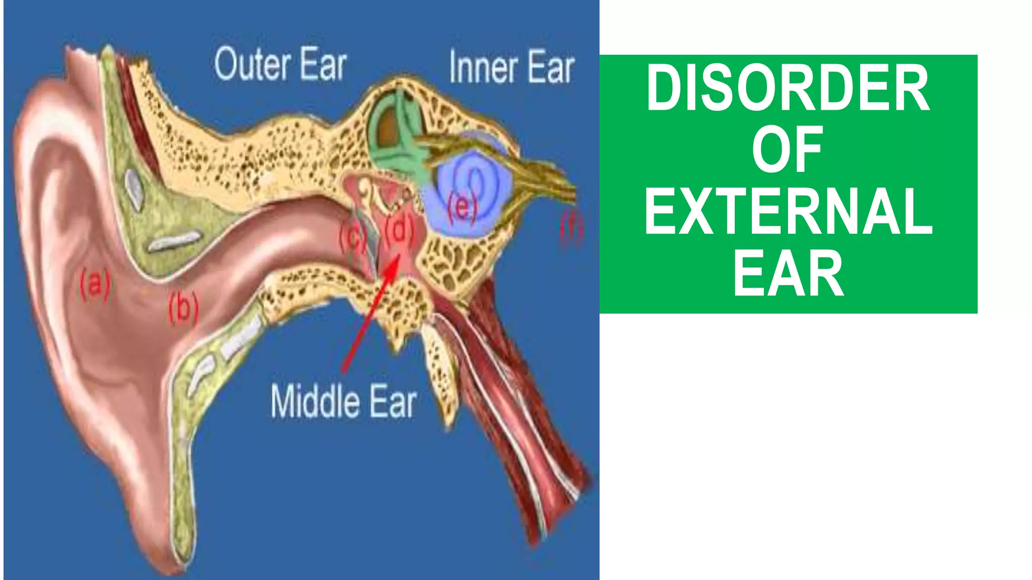 ear disorder.pptx
