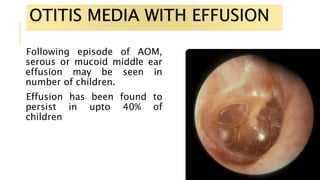 Mucoid Middle Ear Effusion