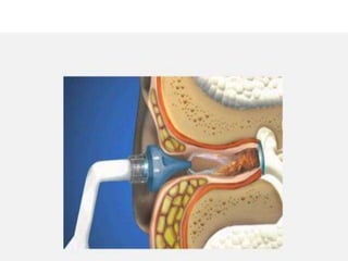 EAR FOREIGN BODY_ WAX IMPACTION .pptx