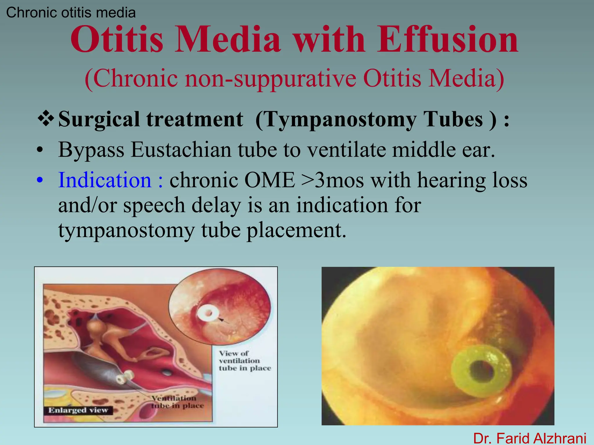 Chronic Otitis Media of Mucosal Type TT Type | PPT