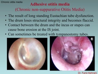 Chronic Otitis Media of Mucosal Type TT Type | PPT