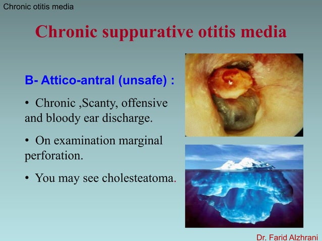 Chronic Otitis Media of Mucosal Type TT Type | PPT