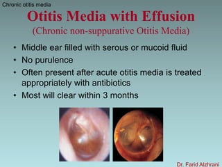 Chronic Otitis Media of Mucosal Type TT Type | PPT