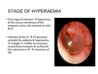Ear infection | PPT