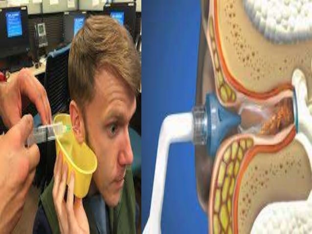 EAR IRRIGATION .pptx | Ear, Nose and Throat Conditions | Diseases and ...