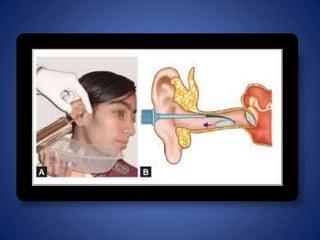 ear Irrigation.pptx