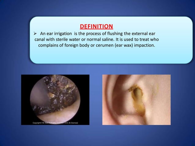 ear Irrigation.pptx