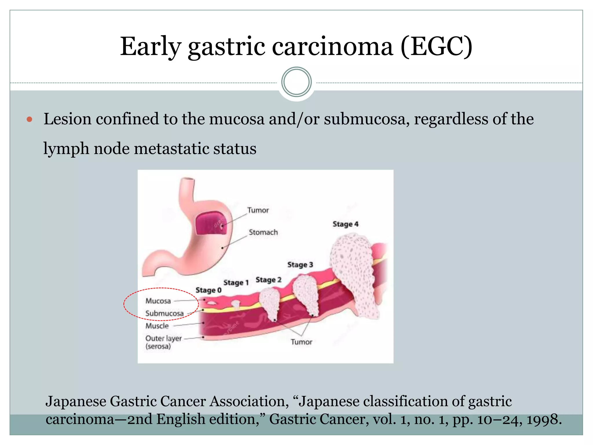 Early gastric cancer | PPT