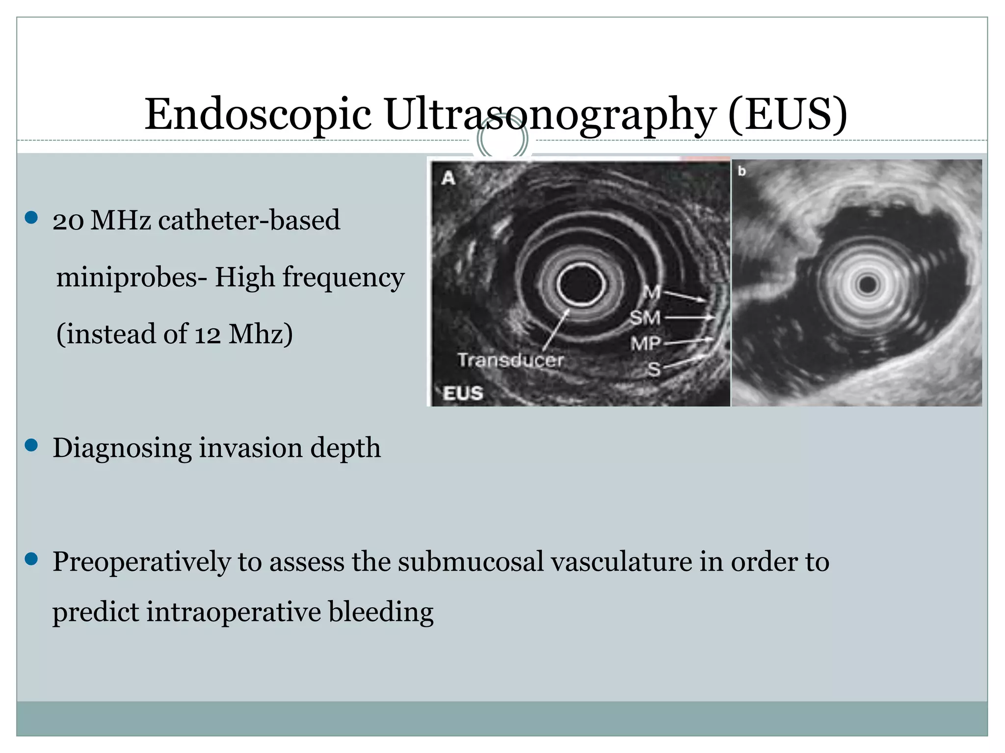 Early gastric cancer | PPTX
