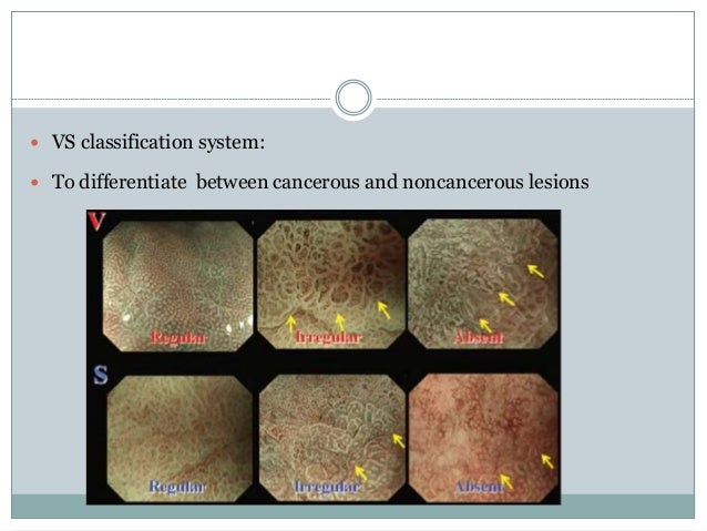 Early gastric cancer
