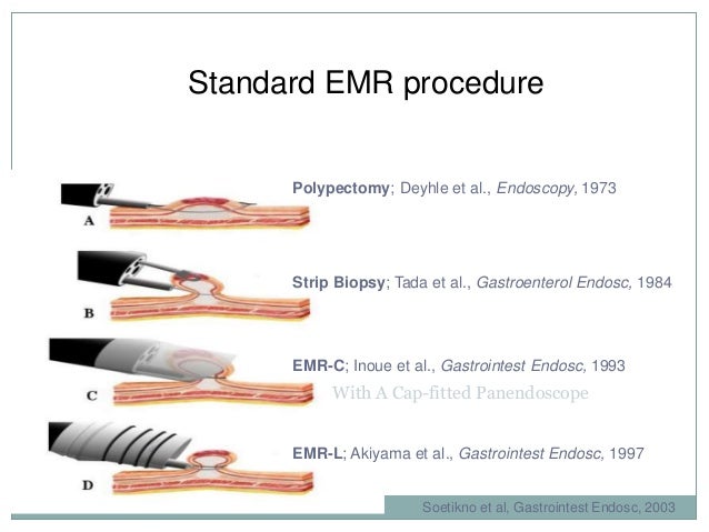 Early gastric cancer