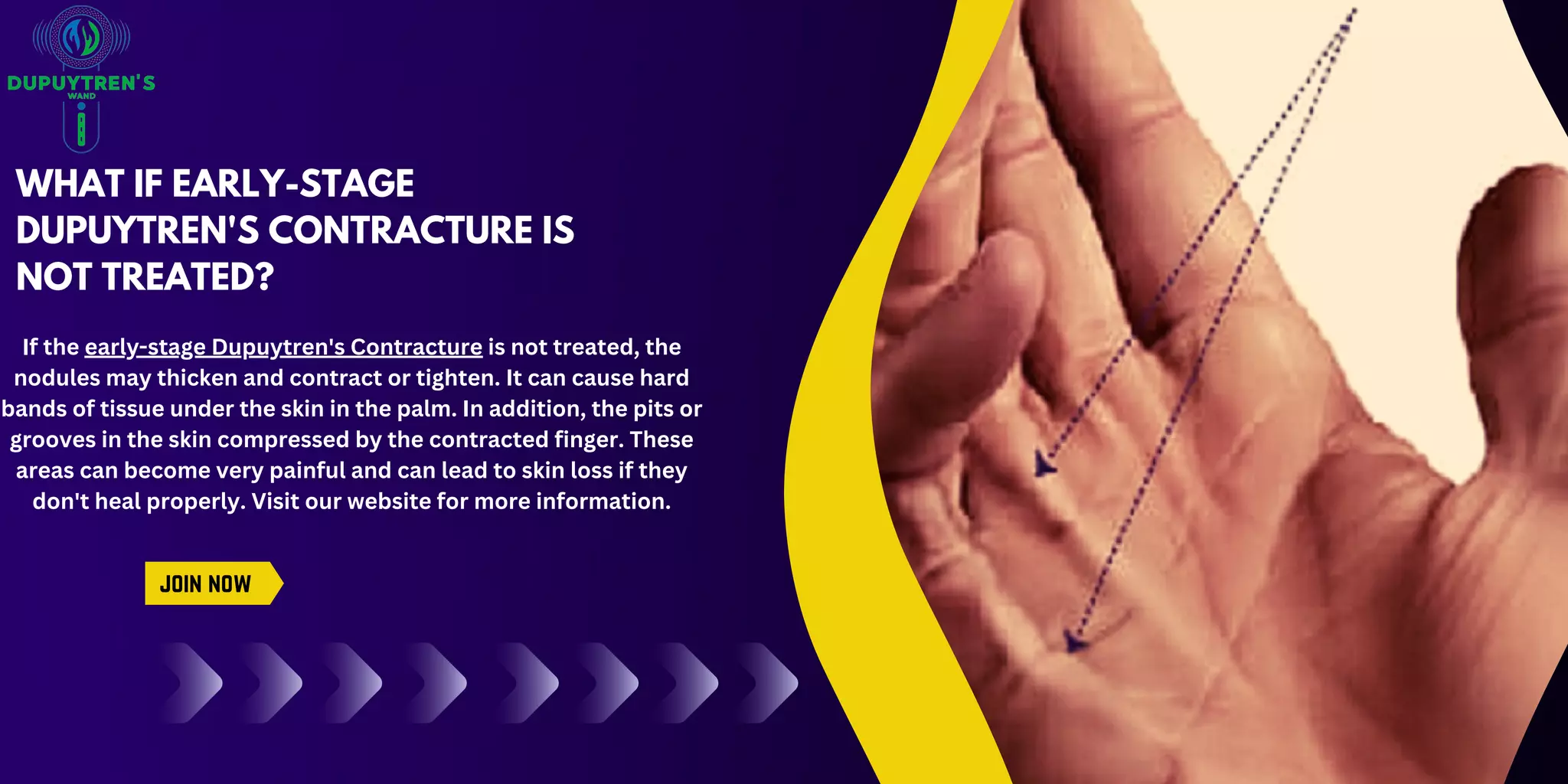 What if early-stage Dupuytren's Contracture is Not Treated? | PDF