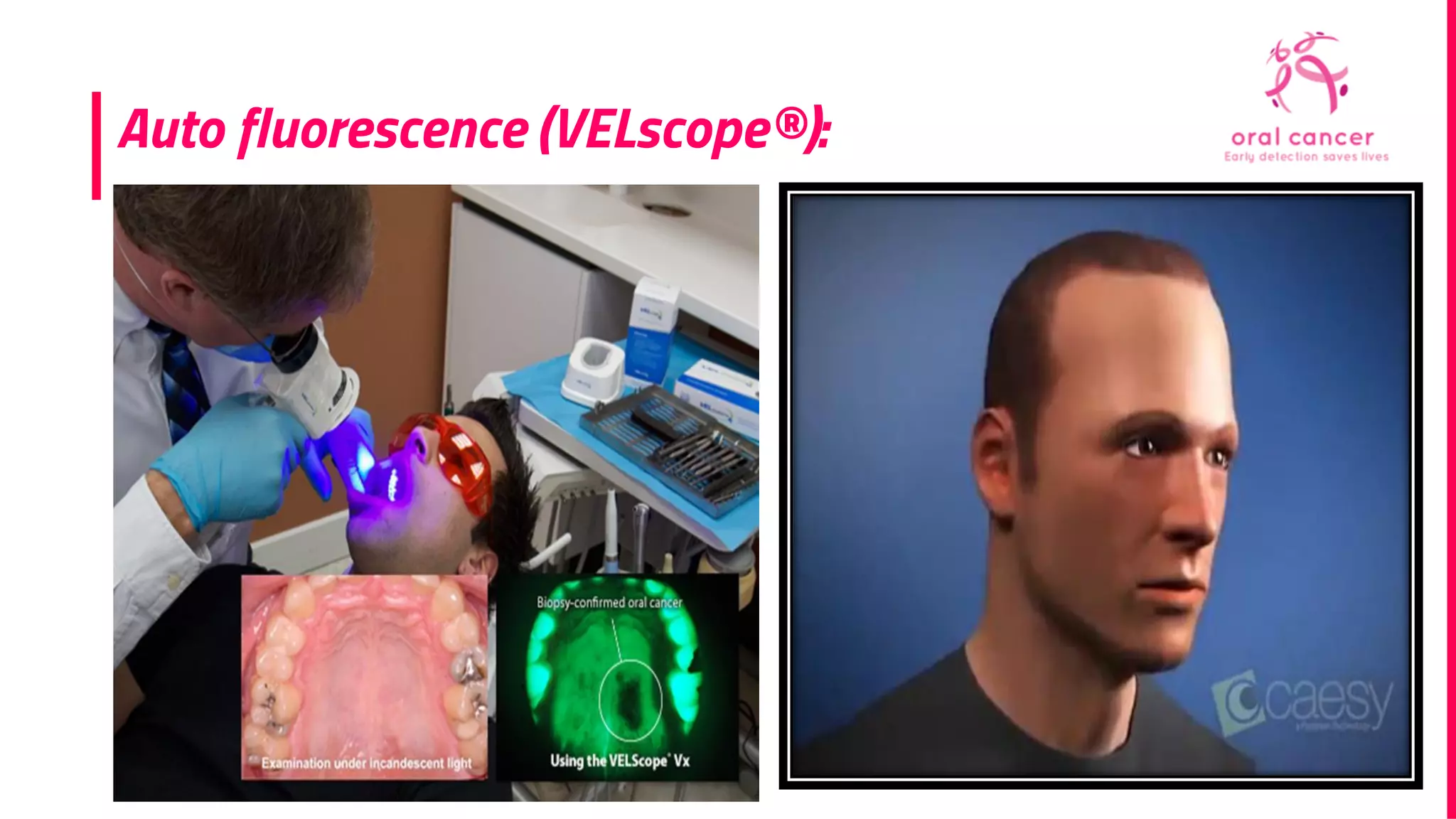 Early cancer detection ( oral cancer ) | PDF