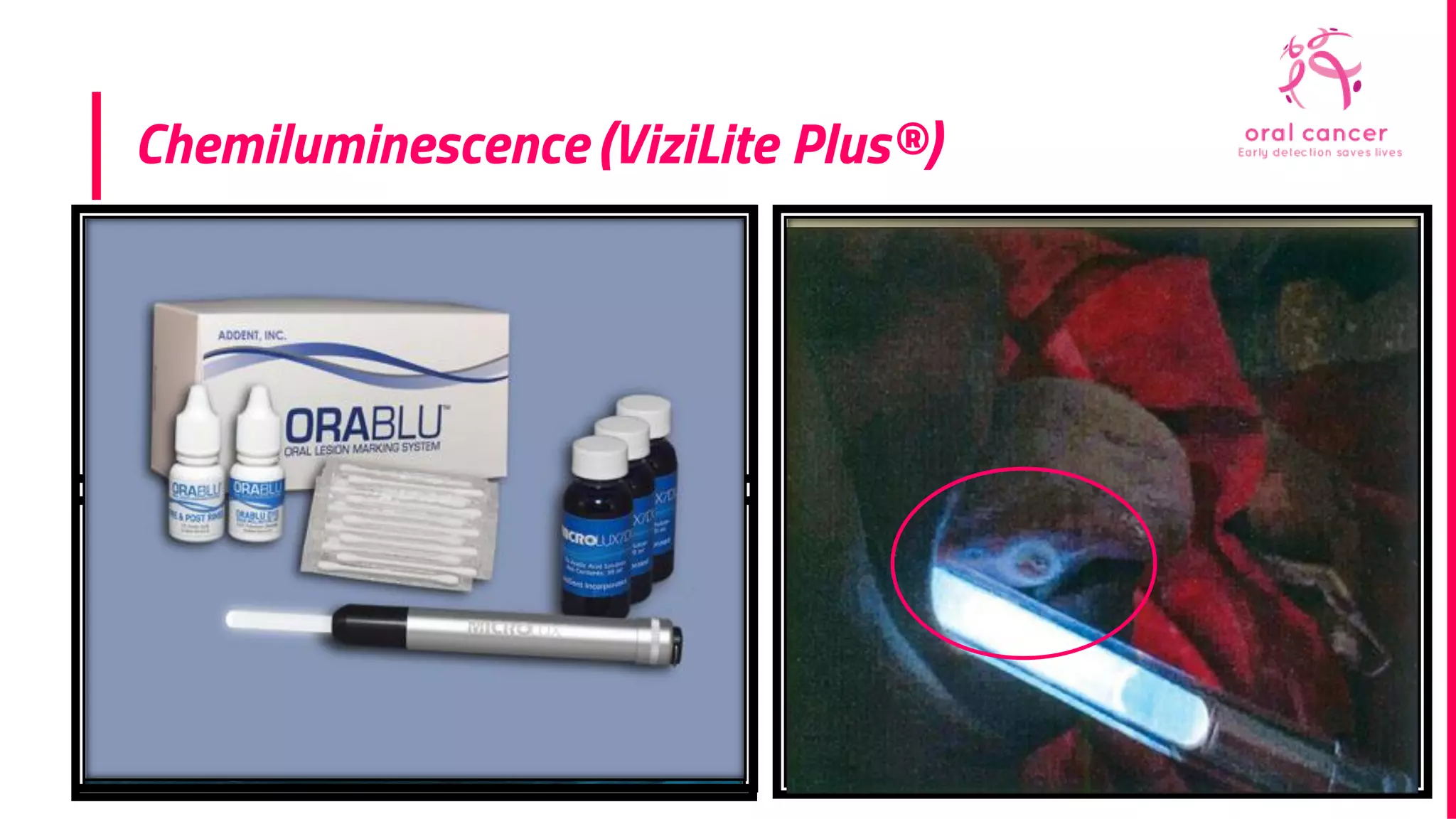 Early cancer detection ( oral cancer ) | PDF | Dental Health | Diseases and Conditions