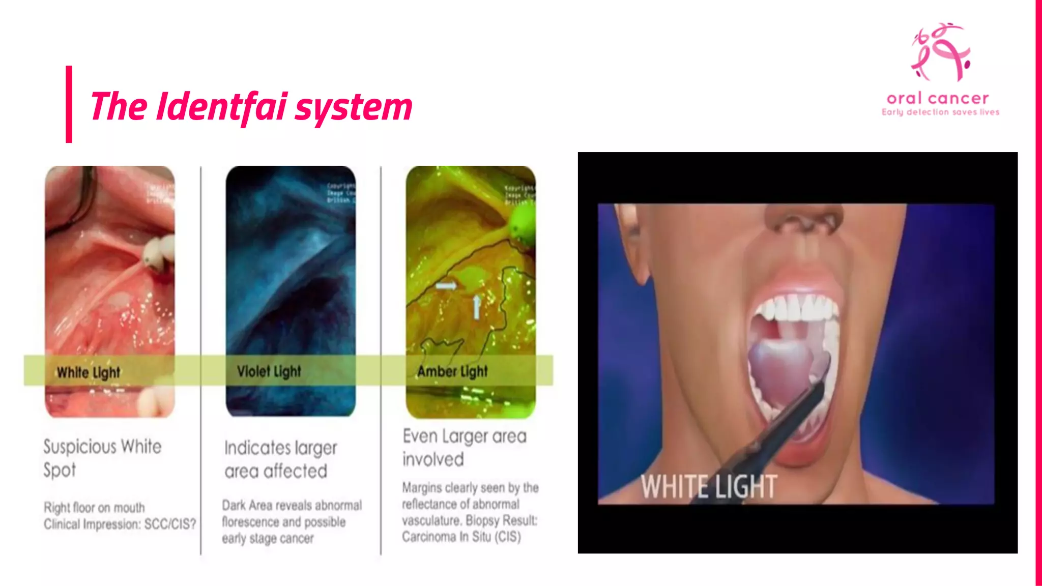 Early cancer detection ( oral cancer ) | PDF | Dental Health | Diseases and Conditions