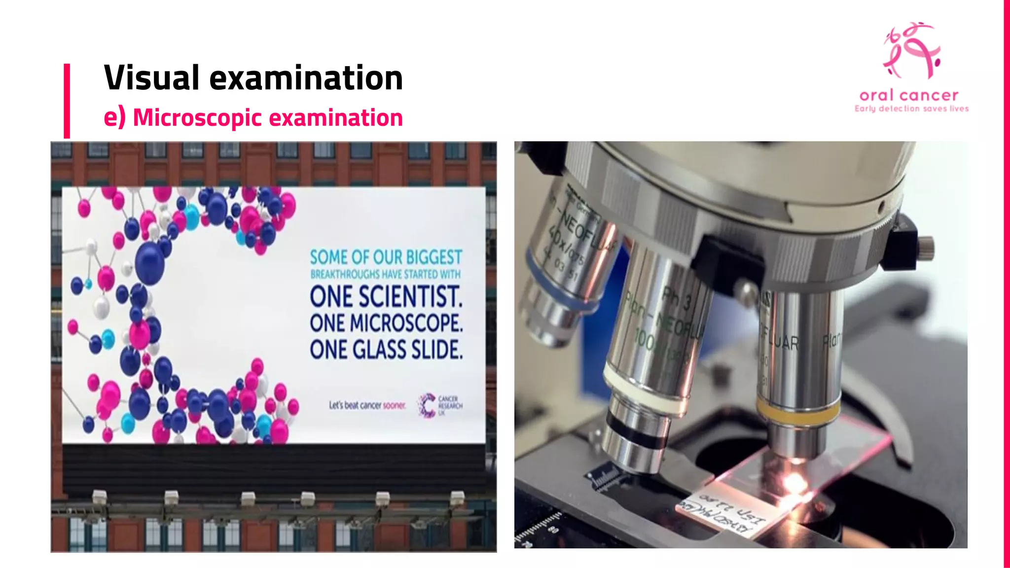 Early cancer detection ( oral cancer ) | PDF | Dental Health | Diseases and Conditions