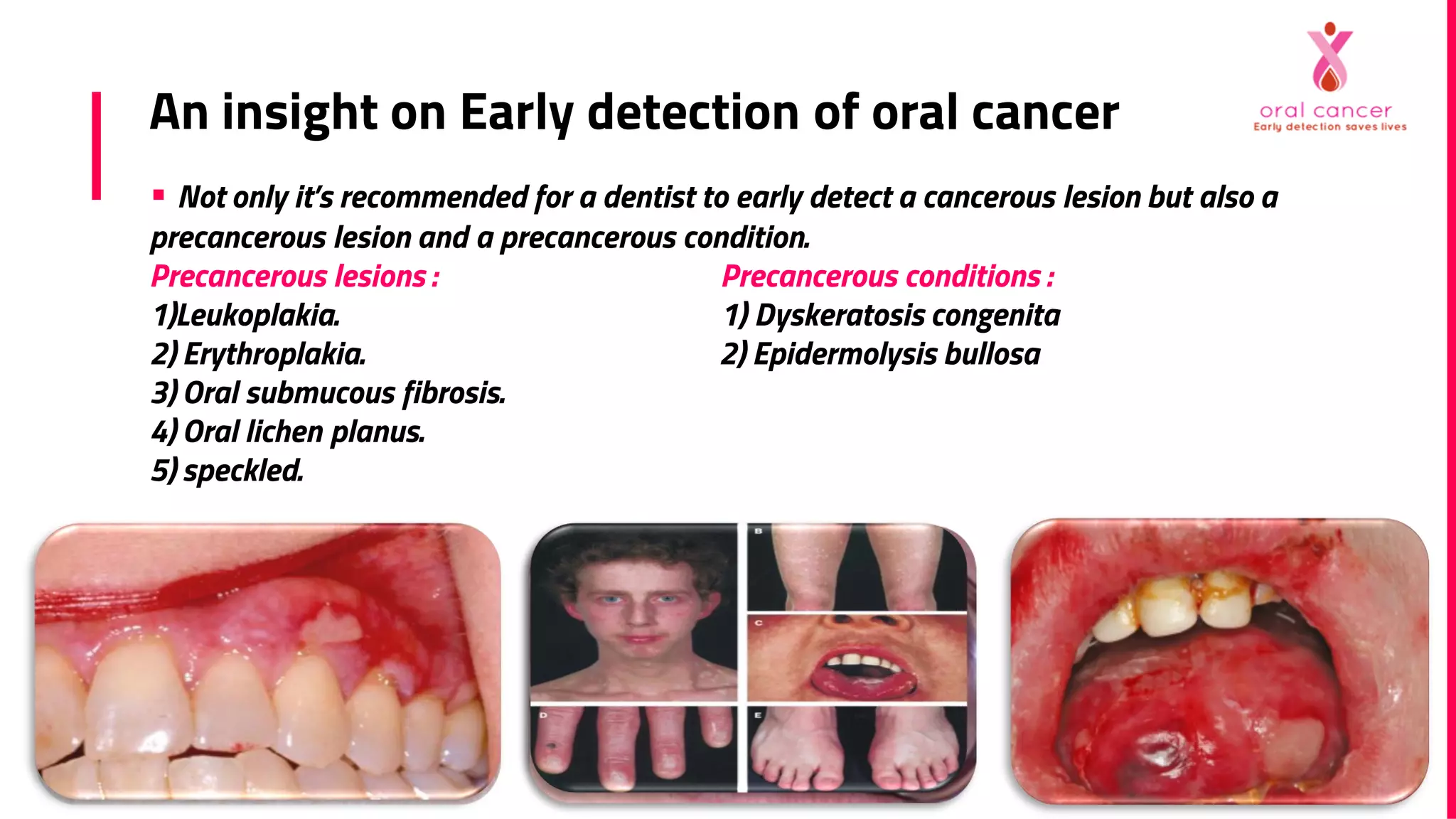 Early Cancer Detection Oral Cancer Pdf