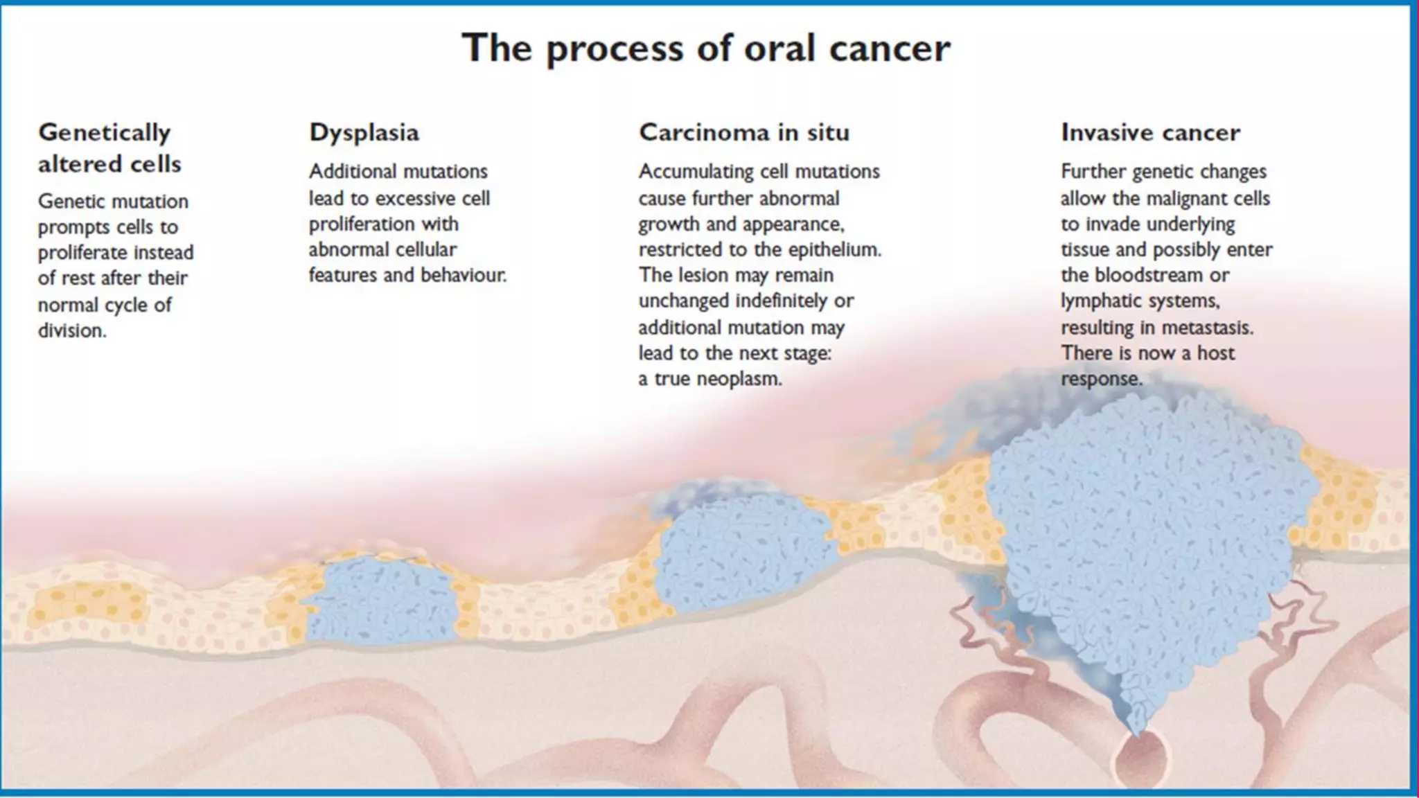 Early cancer detection ( oral cancer ) | PDF