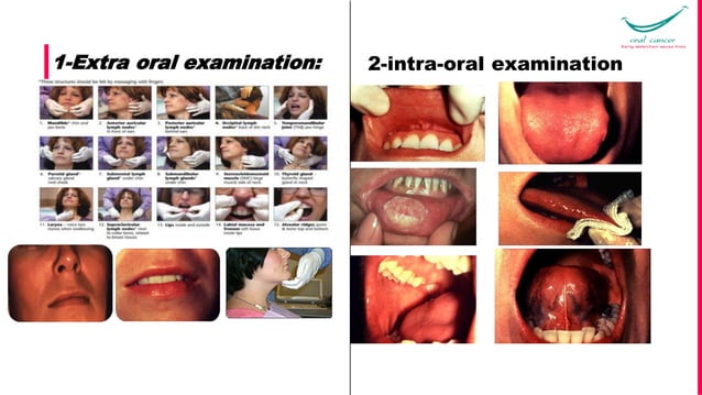 Early cancer detection ( oral cancer ) | PDF | Dental Health | Diseases ...