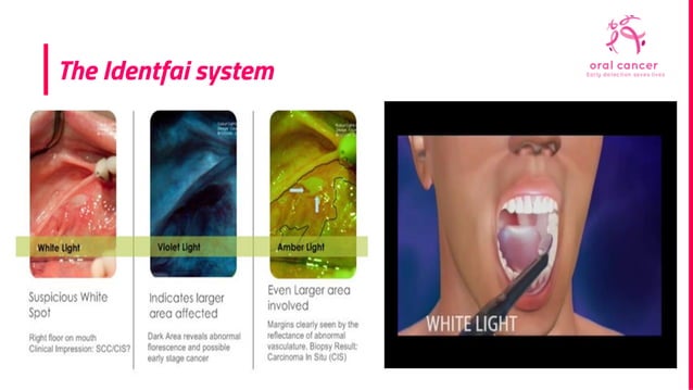 Early cancer detection ( oral cancer ) | PDF | Dental Health | Diseases ...