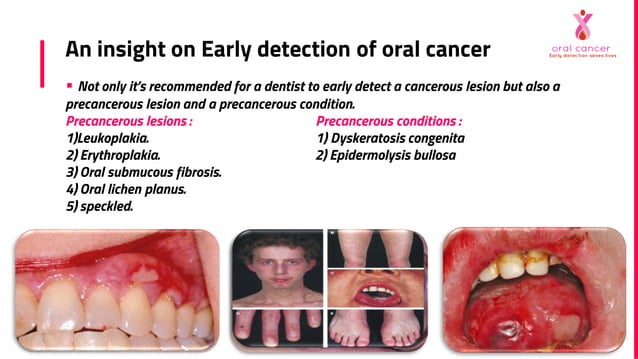 Early cancer detection ( oral cancer ) | PDF | Dental Health | Diseases and Conditions