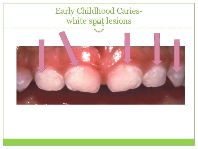 Early Childhood Caries Ppt