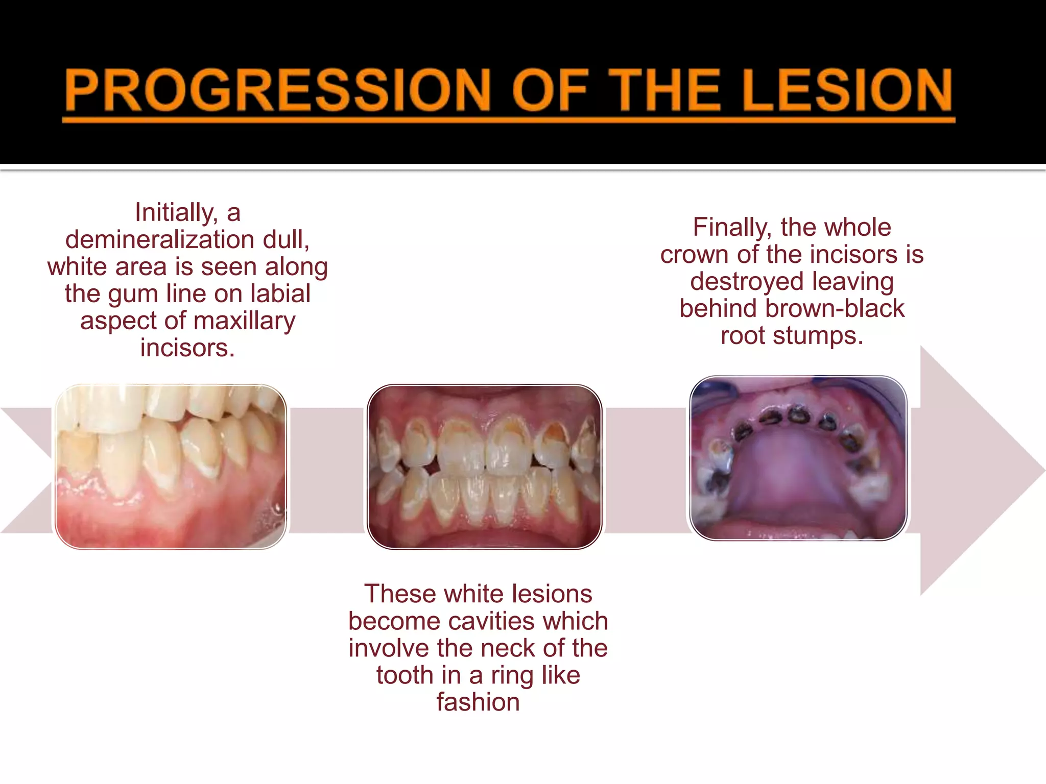 Early childhood caries | PPTX
