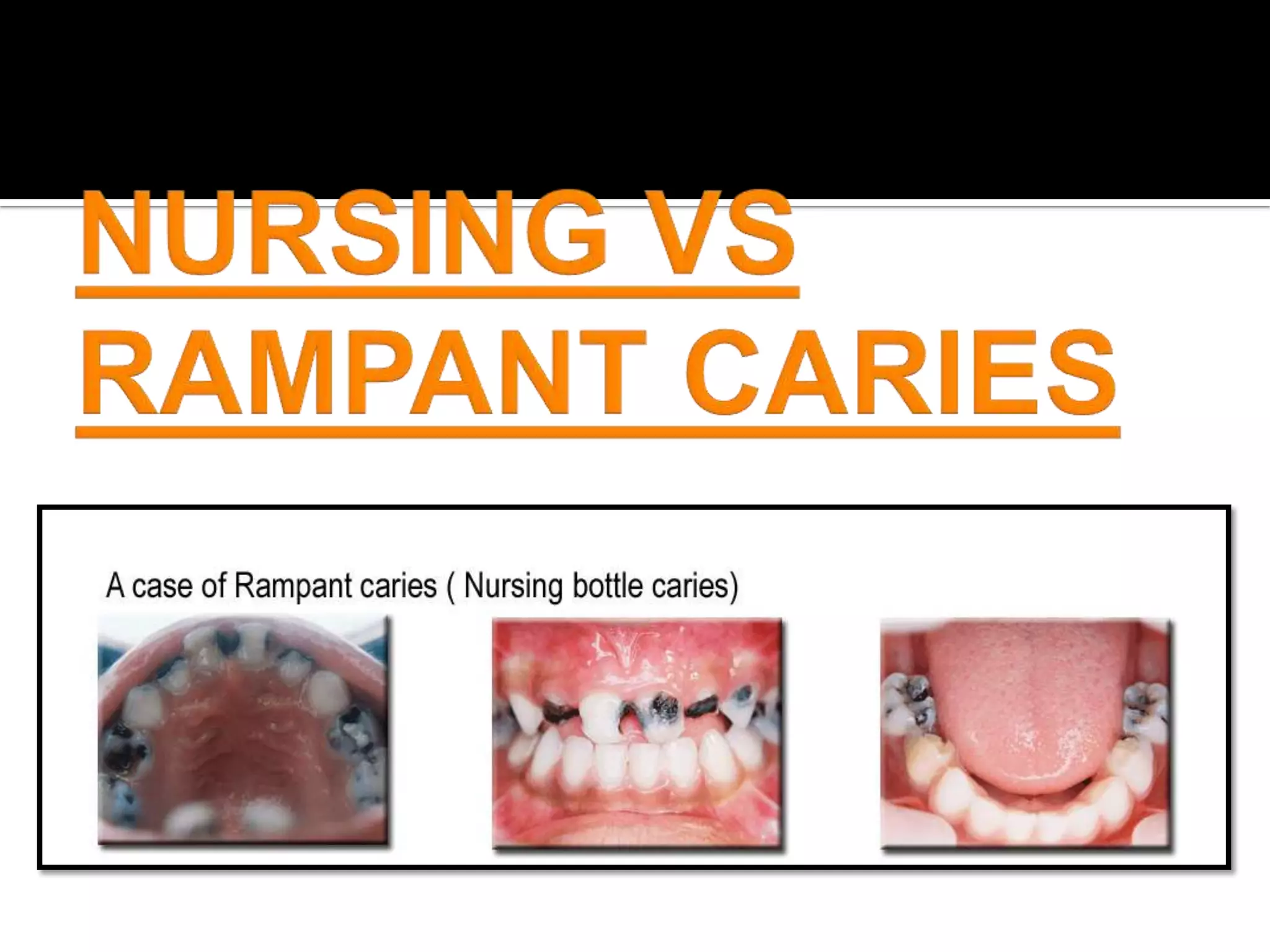 Early childhood caries | PPTX