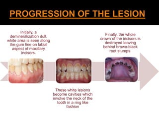 Early childhood caries | PPTX