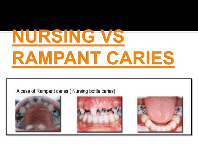 Early childhood caries | PPTX