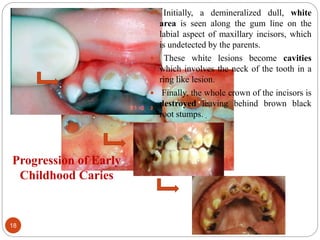 Early childhood caries.ppt