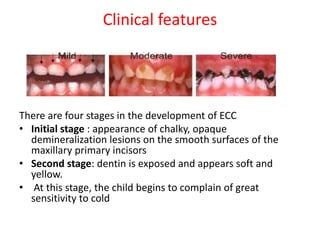 Early Childhood caries-By Dr.Rogers Namanya (Legacy Dental Clinic ...