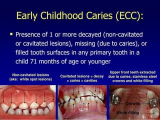 Early Childhood caries-By Dr.Rogers Namanya (Legacy Dental Clinic ...