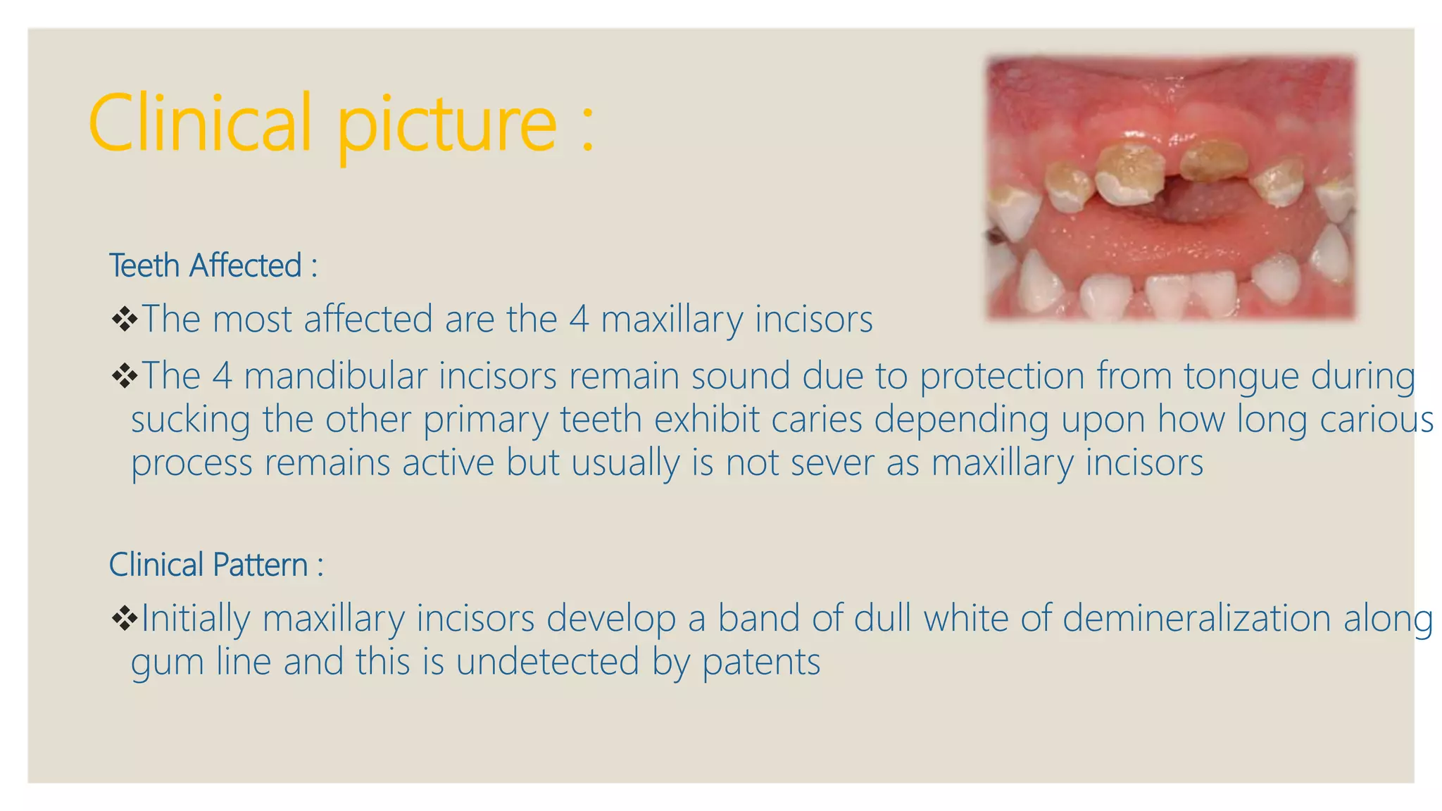 Early childhood caries, rampant, chronic and arrested caries | PPTX