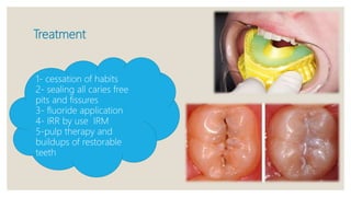 Early childhood caries, rampant, chronic and arrested caries | PPTX