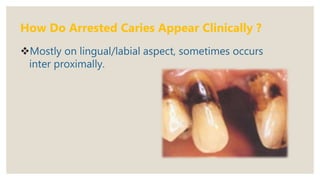 Early childhood caries, rampant, chronic and arrested caries | PPTX