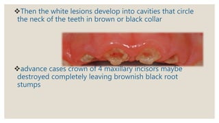 Early childhood caries, rampant, chronic and arrested caries | PPTX
