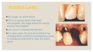 Arrested Caries