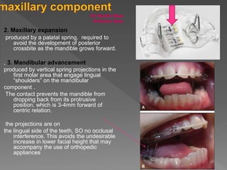 Early class ii division 1 malocclusions | PPTX