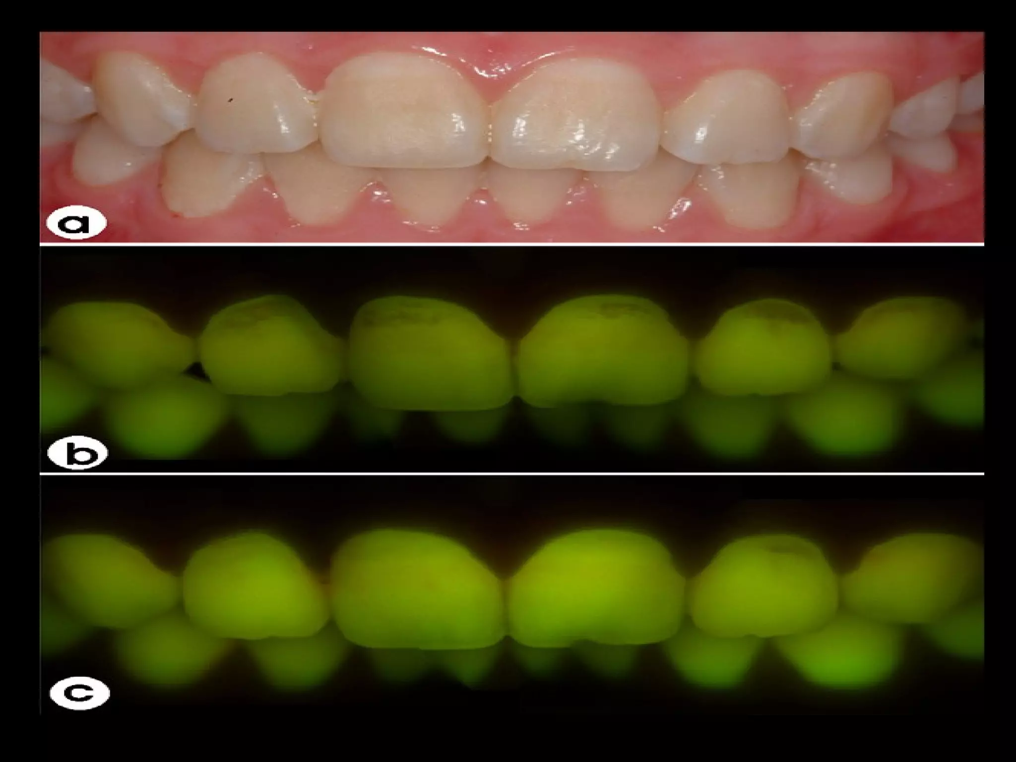 Early detection, diagnosis and quantification of dental caries | PPT