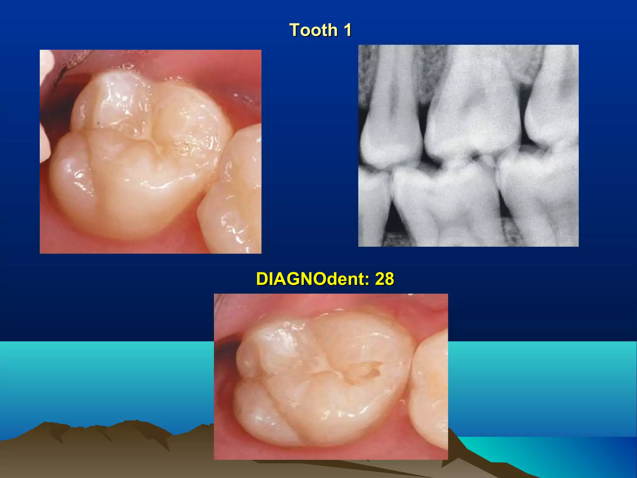 Early detection, diagnosis and quantification of dental caries | PPT