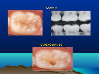 Early detection, diagnosis and quantification of dental caries | PPT