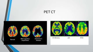 Early diagnosis and management of dementia | PPTX | Brain and Nervous ...