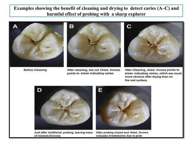 Early diagnosis of caries | PPT