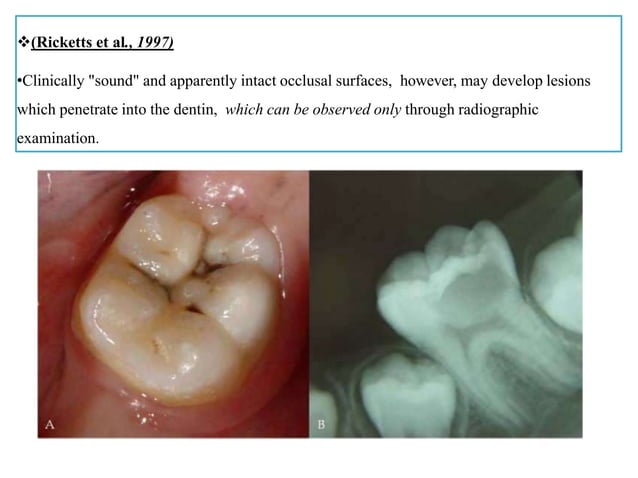 Early diagnosis of caries | PPT